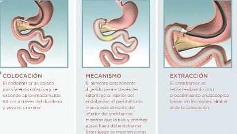 Endobarrier: nuevo tratamiento para combatir la obesidad y la diabetes