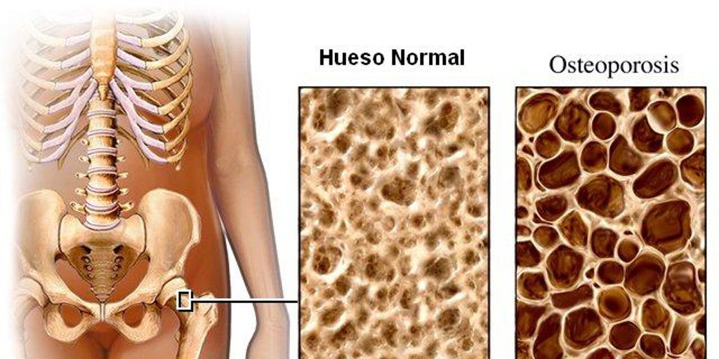 Estos son los síntomas que alertan de un cáncer de hueso