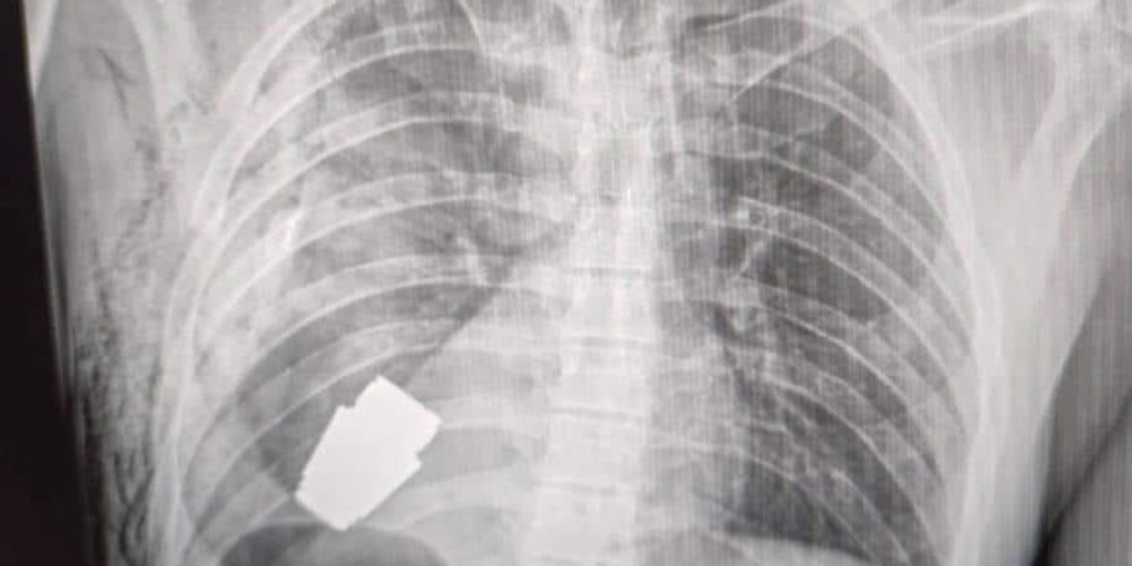 Operado un soldado ucraniano que tenía una granada activa incrustada en ...