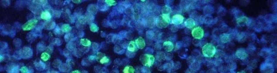 El virus de la mononucleosis, detrás de muchas enfermedades autoinmunes